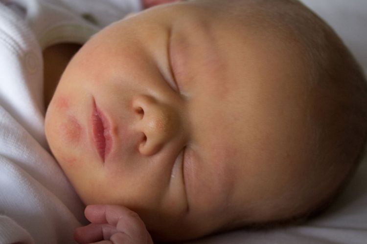 Berikut Penjelasan Newborn Jaundice (Penyakit Kuning pada Bayi) yang #KAMUHARUSTAU!