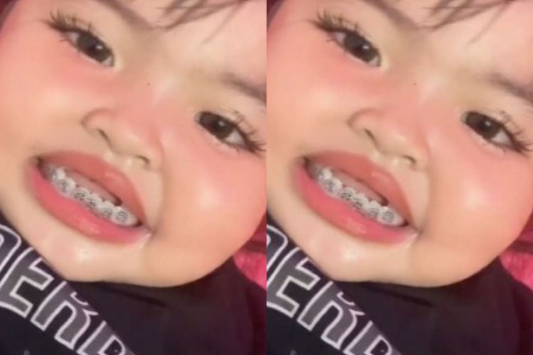 Viral Gadis Kecil Pakai Behel, Mom Wajib Tahu Usia Pemasangan Behel ...