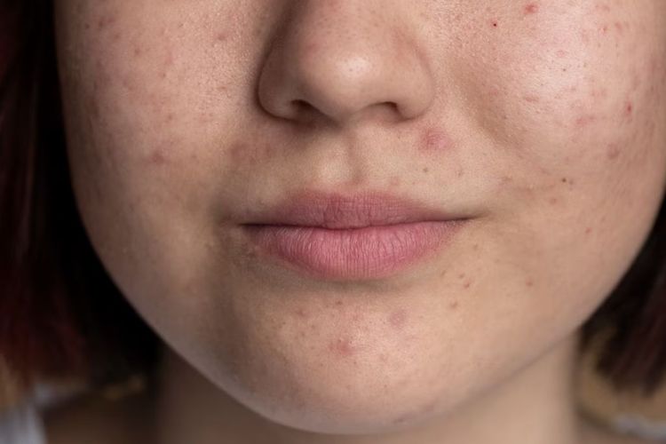 3 Ciri-ciri Purging yang Setelah Memakai Skincare Bahan Aktif